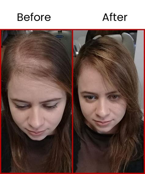 Hair Prp Before After 3d Lifestyle Pk 3d Lifestyle Pk