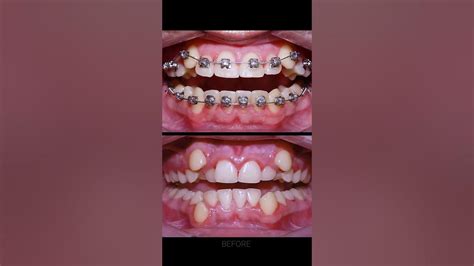 Braces Process Youtube