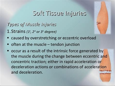 Types Of Soft Tissue Injuries 136 Soft Tissue Injuries Pczxr
