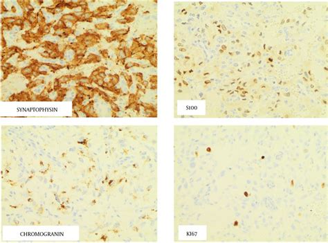 Immunohistochemical Staining Showing Positivity For Synaptophysin Download Scientific Diagram