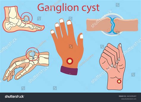 Ganglion Cystsoft Gel Like Massessmooth Roundwelling Stock Vector