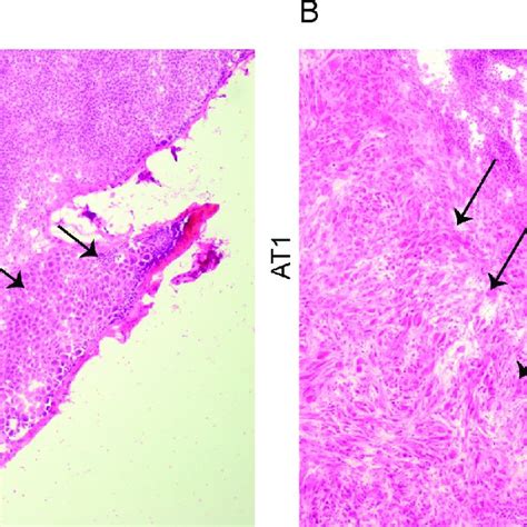Lymph Node Metastases Sections From Regional Lymph Nodes From Rats Download Scientific Diagram