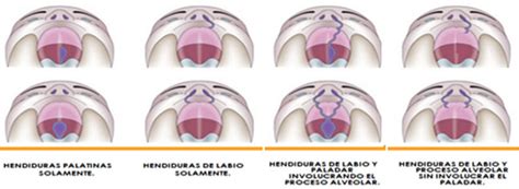 Seminario Interdisciplinario Grupo 2016 2 Labio Y Paladar Hendido Cd
