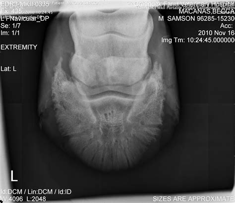 Riding Through The Fear Adventures In Congenital Bipartite Navicular Syndrome
