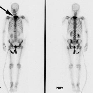 Technetium 99m Methylene Diphosphonate Whole Body Bone Scan Shows Download Scientific Diagram