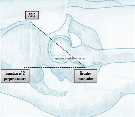 Bryants Triangle Examination Of Hip Epomedicine Bryants Triangle Examination Of Hip Epomedicine