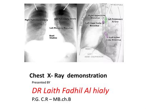 Chest X Ray Pptx Lung And Respiratory Health Diseases And