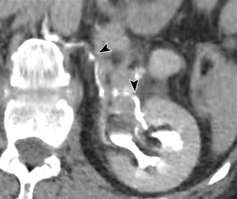Imaging Of Perirenal And Intrarenal Lymphatic Vessels Anatomy Based
