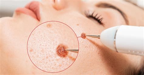 Cryotherapy Scar Removal An Overview Best Female Plastic Surgeon In
