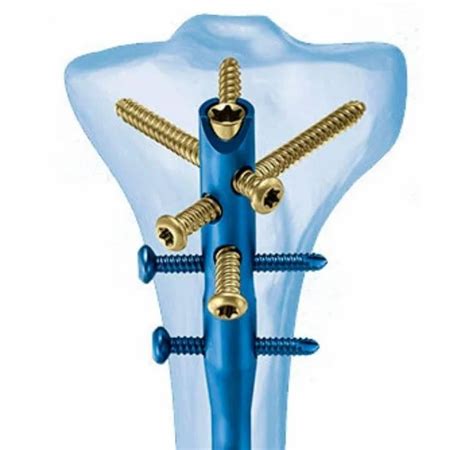 Titanium Interlocking Expert Tibial Nail At Rs 3000 In New Delhi Id 2854227348597