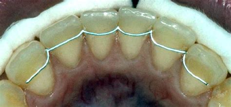 SCHEU DENTAL Custom Made GmbH MEMOTAIN