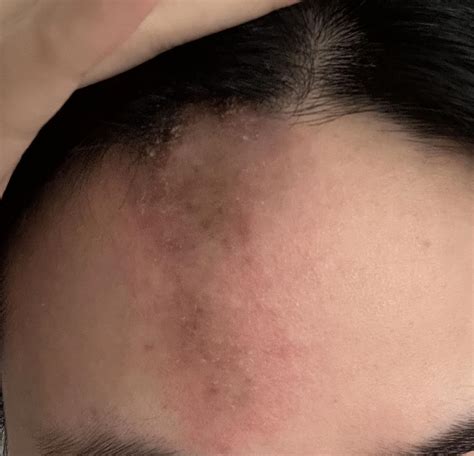 局限性硬皮病治疗过程 知乎