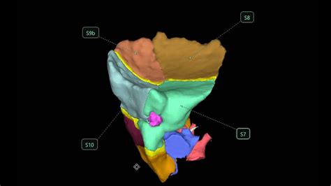 3d Ds Ep 8 Right S7 Segmentectomy Youtube