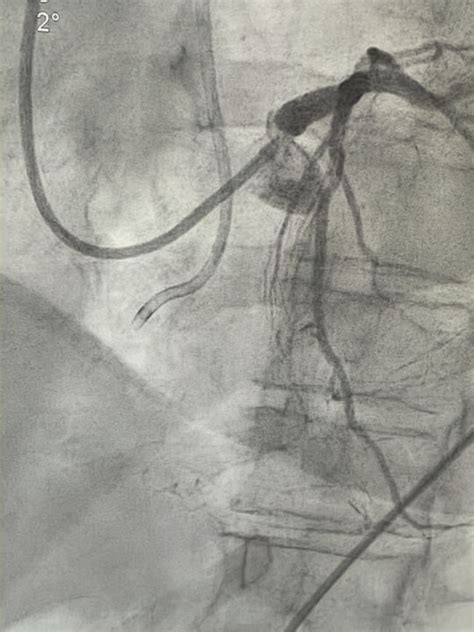 Andrea Mangiameli On Linkedin Male 67 Years Old Large Inferior Ischemia Fe 38 J Cto 3 Blunt…