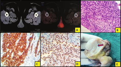 A Positron Emission Tomography Scan Showing Increased Tracer Uptake Download Scientific