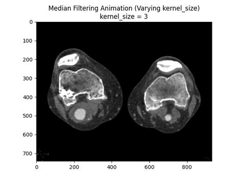 Ct Scan Pre Processing To Enhance Paa Segmentation Accuracy