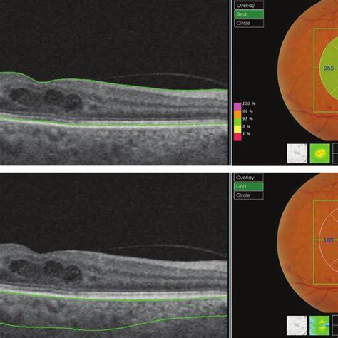 Ss Oct Scans Showing Retinal A And Choroidal B Thickness Maps Download Scientific Diagram