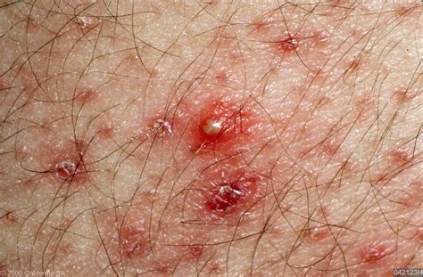 Topical Antibiotics For Genital Folliculitis At Charles Kintore Blog