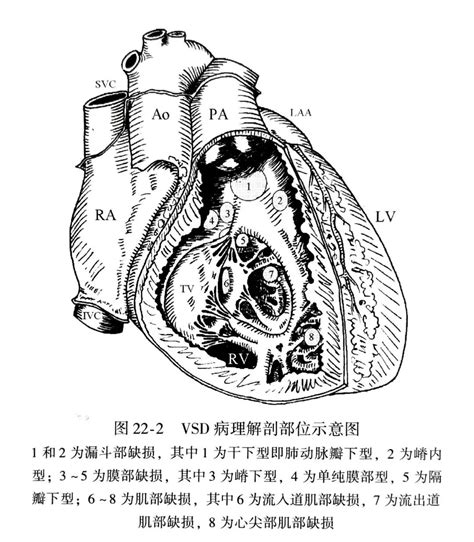 室间隔缺损（vsd） 肺动脉高压 心室 超声 分流 健康界