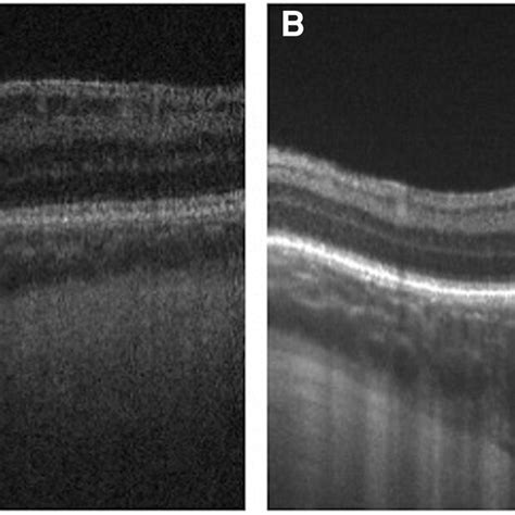 Handheld Swept Source Optical Coherence Tomography Images Obtained From Download Scientific