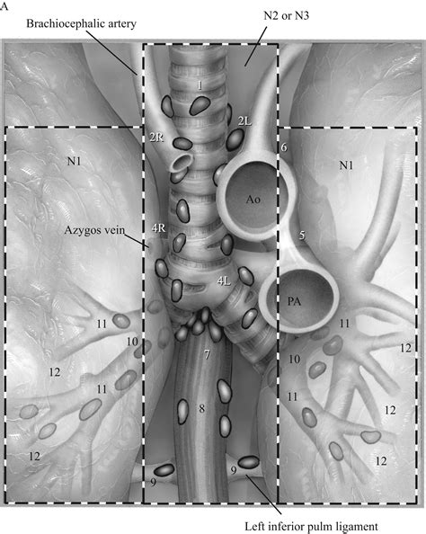 Video Assisted Thoracoscopic Bilobectomy Operative Techniques In