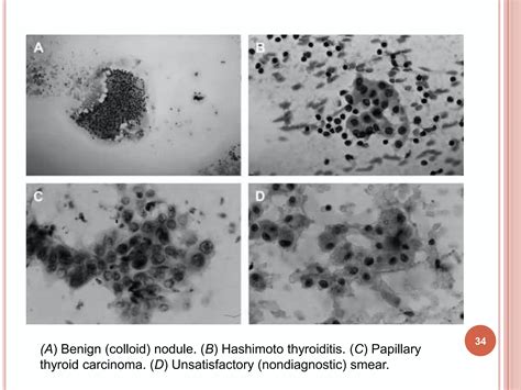 Solitary Thyroid Nodule Pptx