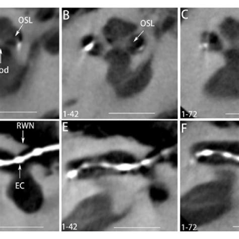 Pdf Imaging Optimization Of Temporal Bones With Cochlear Implant