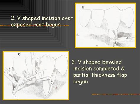 Lateral Pedical Graft