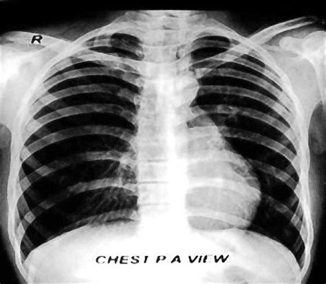 Chest X Ray Showing Mediastinal Shift To Left Crowded Vascular