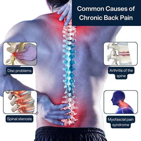 7 Ways To Treat Chronic Back Pain Without Surgery Pain Management Nyc