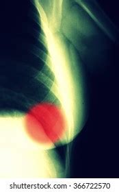 Breast Xray Photo Stock Photo Shutterstock