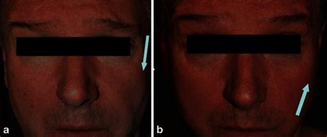 A Voluntary Subject 4 Weeks After Injection Of Three Botox Units In Download Scientific