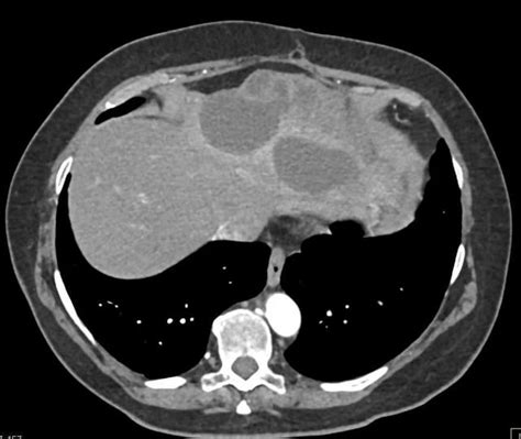 Cystic Cholangiocarcinoma R Radiology