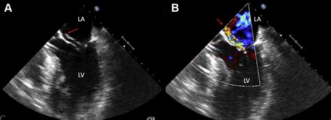 Papillary Muscle Rupture Complicating Acute Myocardial Infarction A