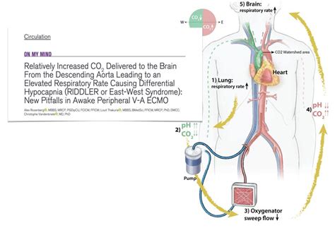 Ecmo Ecls Pocus Marta Velia Antonini