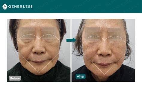 제너리스의원 연신내점│연신내피부과│은평구피부과