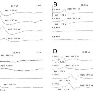 Examples Of SSR Recordings In A A Normal Subject B A Patient With Download Scientific