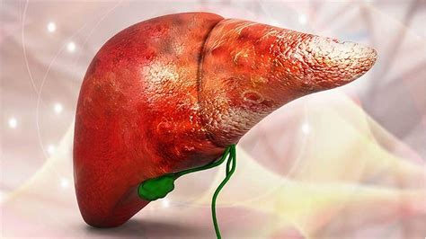 Hội Thảo Thực Hành Quản Lý Bệnh Nhân Ung Thư Gan Cập Nhật Vai Trò Của