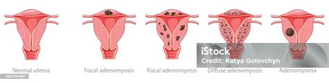 아데노미증 초점 확산 아데노마이종 및 정상적인 자궁 인간 해부학 여성 생식 병기 시스템 장기 위치 계획 아이콘 벡터 의료 만화 평면 일러스트 는 흰색에 고립 자궁선근증에