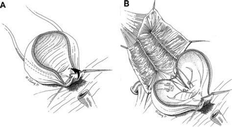 Bladder Mitrofanoff