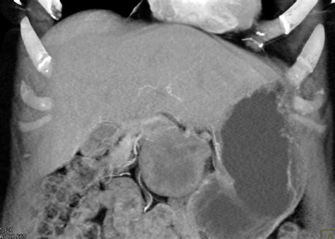 Gist Tumor Off Gastric Antrum Stomach Radiology Case Studies Ctisus