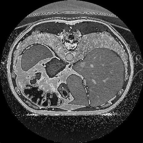 lung cancer segmentation instance segmentation dataset and pre trained model by ella azzahra
