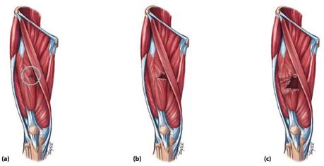 Grade 3 Hamstring Tear Symptoms Jtcp