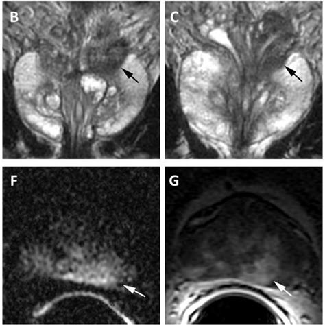 Pdf Prostate Imaging Reporting And Data System Version 2 1 2019 Update Of Prostate Imaging