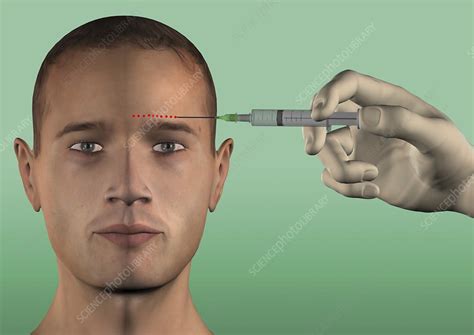 Supratrochlear Nerve Block
