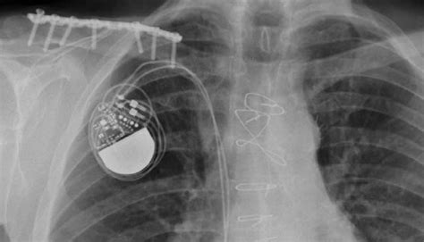 Postoperative X Ray Control After Pacemaker Implantation Download Scientific Diagram