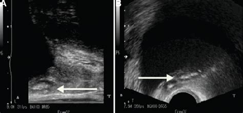 Idiopathic Pan Genital Tract Calcification A Rare Cause Of Aspermia And Infertility Abstract