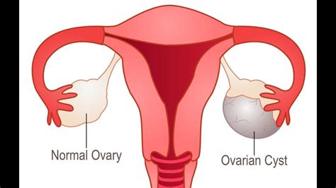 Cpt Code For Cystectomy Partial Simplify Medical Coding Youtube