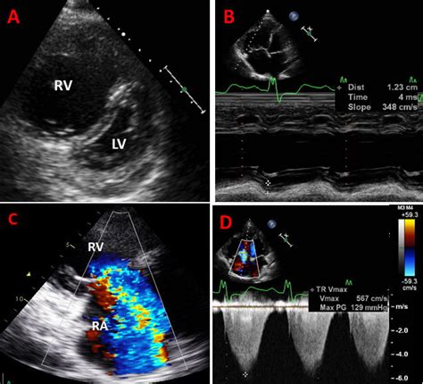 Examples Of Images Obtained From Patient With Pulmonary Hypertension Download Scientific