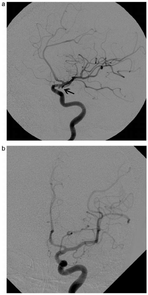 Cerebral Aneurysm Angiogram Comparison Of 2d And 3d Digital
